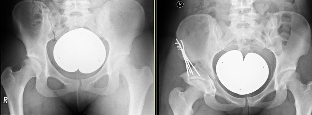 Beckenosteotomie - periazetabuläre Osteotomie nach Ganz (PAO)